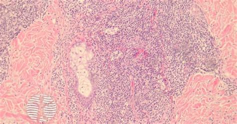 Pathology Of Discoid Lupus Erythematosus Image