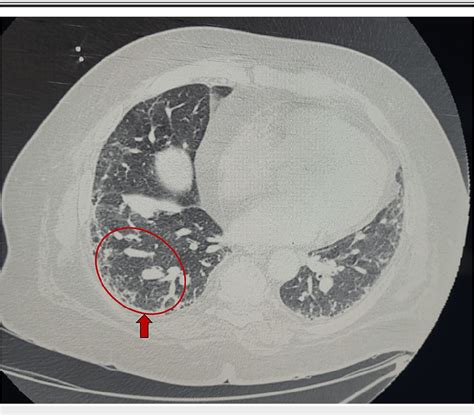 Figure 2 From Thoracic Segmental Spinal Anesthesia For Emergency