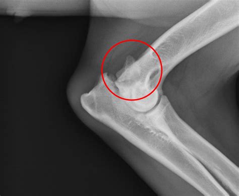 Elbow Fractures Fractures Fracture Dislocation Disloc