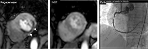 Perfusion Defect On Regadenoson Perfusion Cardiovascular Magnetic Download Scientific Diagram