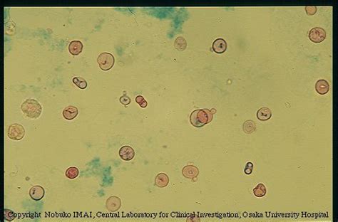 Dysmorphic Red Blood Cells From The Urinary Sediment Of A Patient With Cystitis In A Case Of