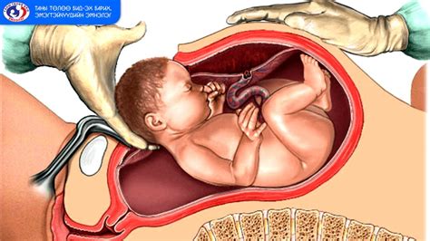 Кесар мэс засал Таны төлөө бид Эх барих эмэгтэйчүүдийн эмнэлэг