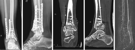 Fractures Of The Tibial Pilon Musculoskeletal Key