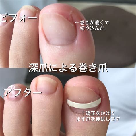 深爪！巻き爪！ 足のケア＆巻き爪ms白金通り店