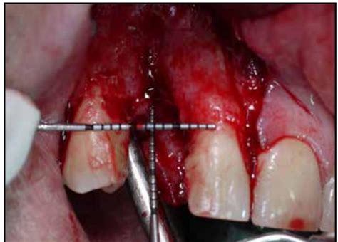 E Full Thickness Flap Exposing Bone Defect