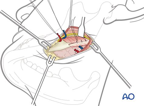 Submandibular Approach