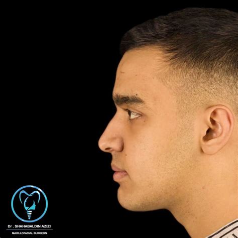 جراحی فک بالا و پایین