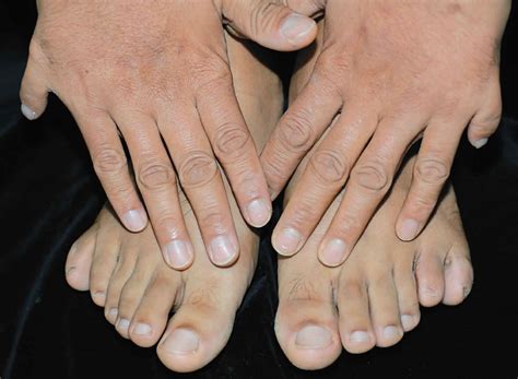 30 Facts About Dandy Walker Malformation Postaxial Polydactyly