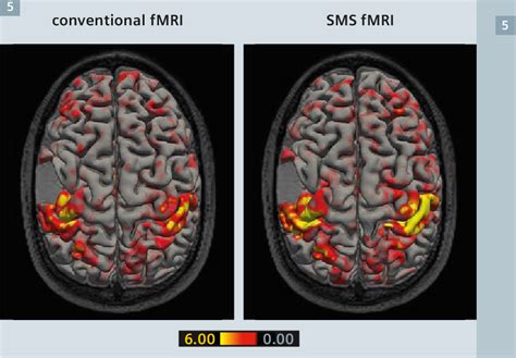 Figure 1 From Rapid High Spatial Resolution Diffusion Mri At 7 Tesla Using Simultaneous