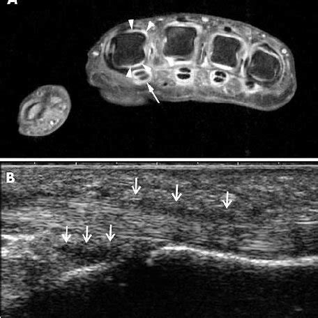 Finger Joint MCP II A The MR Image Shows The MCP Joints IIV In Download Scientific
