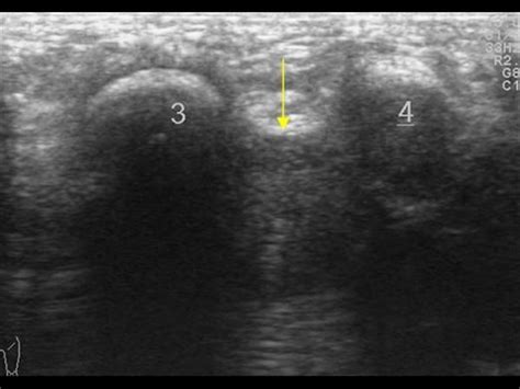 Musculoskeletal Joints And Tendons 68 Foot Case 681 Mortons