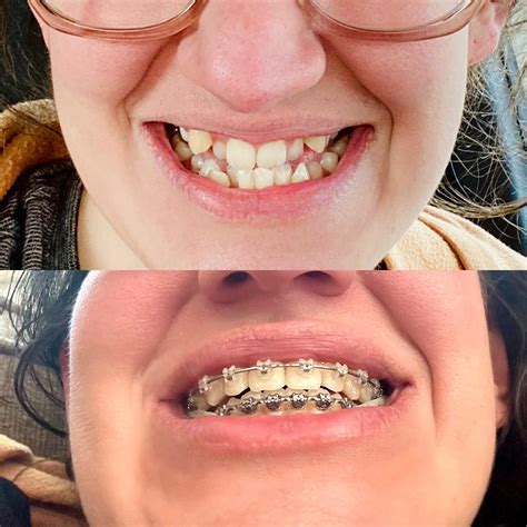 10 Months In Made It To The Other Side Of An Underbite Rbraces