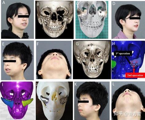 新研究评估了 3D 打印钛植入物对骨骼生长的有效性 知乎