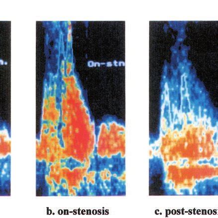 Characterization Of Doppler Waveform At Different Zones Along The Download Scientific Diagram