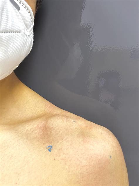 Acromioclavicular Joint Dislocation R Neverbrokeabone