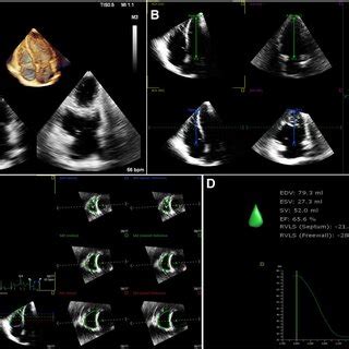 Rv Three Dimensional Image A Three Dimensional Image Of RV Focused Download Scientific