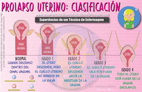 Prolapso Uterino Clasificación Enfermería Ilustrada