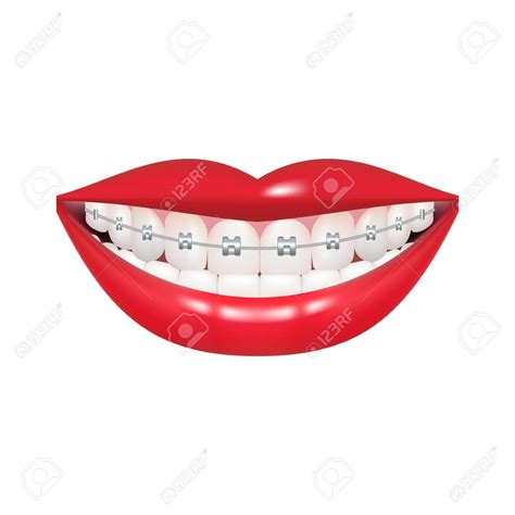 How To Draw Braces On Teeth Easy Warehouse Of Ideas