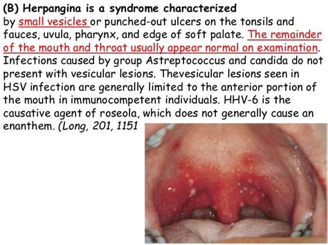 Herpangina In Adults
