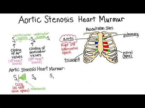 Aortic Stenosis Murmur