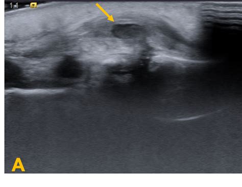 Selstoc A Sternal “do Not Touch” Lesion Eurorad