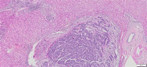Human Liver Metastatic Adenocarcinoma Ffpe Sections