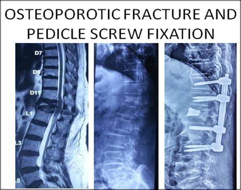 Pedicle Fracture