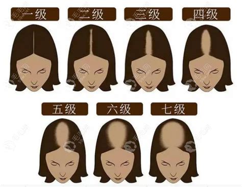 脱发级别相关信息 文章 资讯 图片 毛毛网