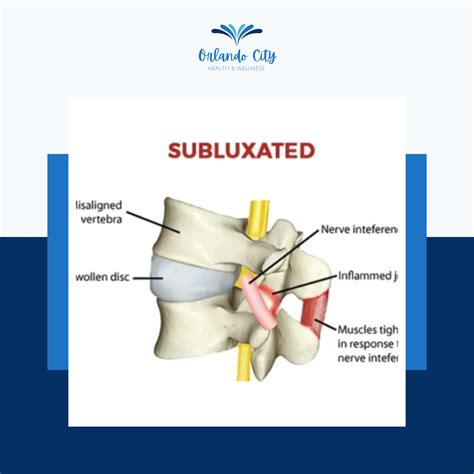 Understanding Subluxation How Chiropractic Care Can Help — Orlando City Health
