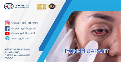 Нүдний даралт