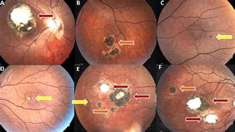 Immunological And Immunogenetic Parameters On The Diversity Of Ocular