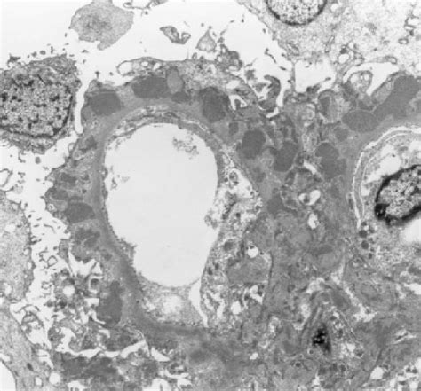 Electron Microscopy Of The First Renal Biopsy Shows A Glomerular