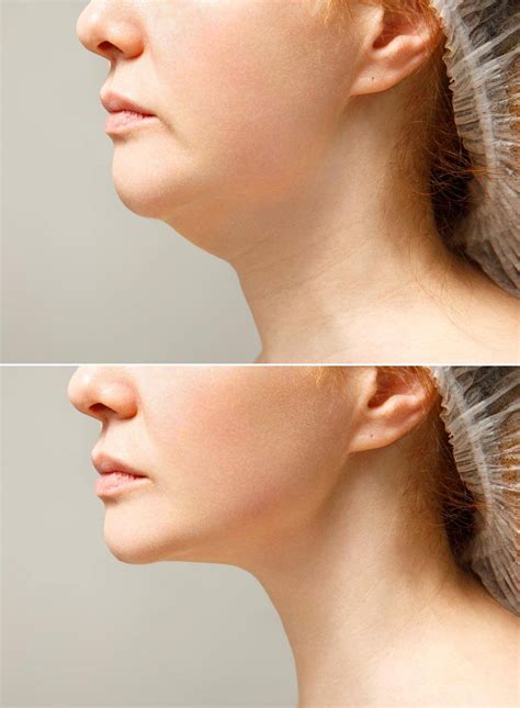 Chin Augmentation Surgery Summer Plastic Surgery