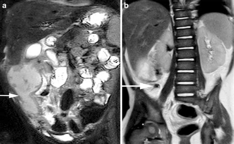 Perforated Appendicitis With Abscess MRI In A Non Sedated 1 Year Old Download Scientific