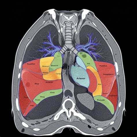 Ct Scan Of Human Thorax With Superimposed Colored Segments On The Lungs