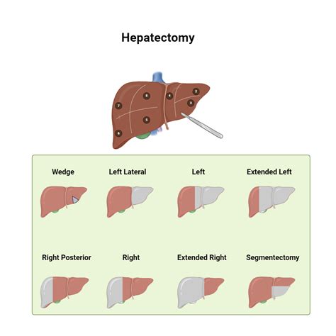 Hepatectomy Types Biorender Science Templates