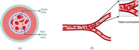 Figure 1 From Detection Of Sickle Cell Disease Using Deep Neural