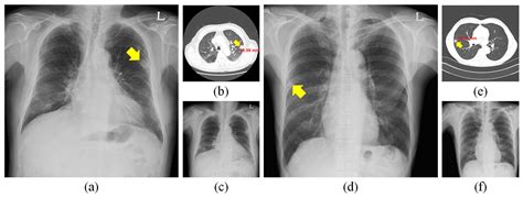 lung cancer xray tumor