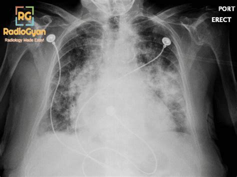 Bat Wing Appearance Radiology Signs