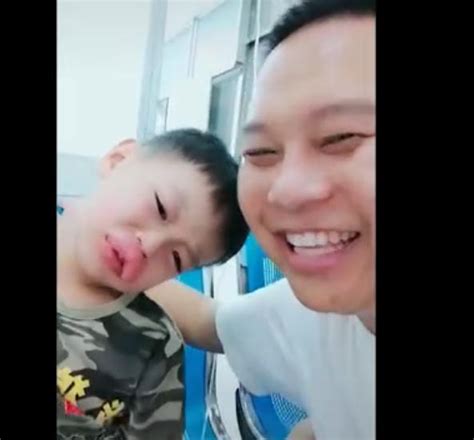 娃吃葡萄过敏，嘴唇嘟嘟，亲爹：虽然心疼但太好笑了！百科ta说