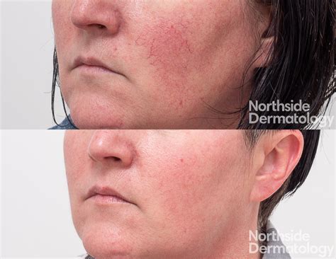Laser Treatments For Redness At Rafael Gilliam Blog