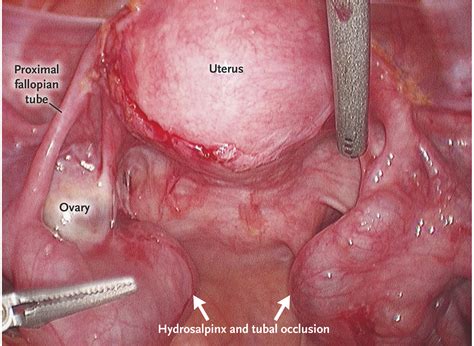 Chlamydia Std In Women