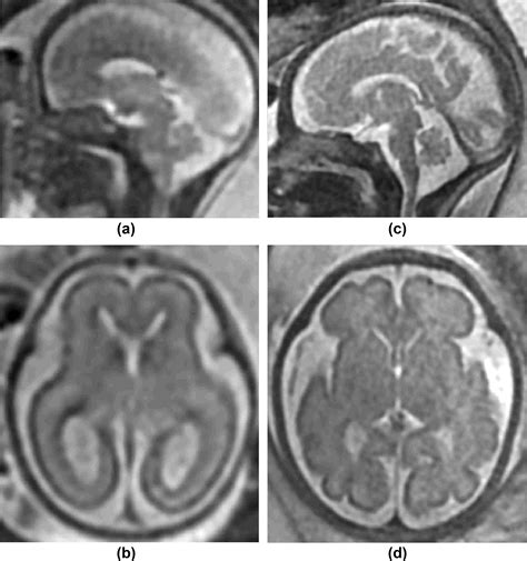 Cerebellar Vermis Mri