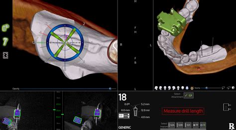 How X Guide Dynamic Navigation Works In Dental Implant Surgery