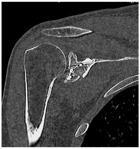 The Role Of Arthroscopy In Contemporary Glenoid Fossa Fracture Fixation