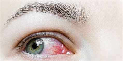 Eye Redness Causes Danger To Eyes Birinci Göz Hastanesi