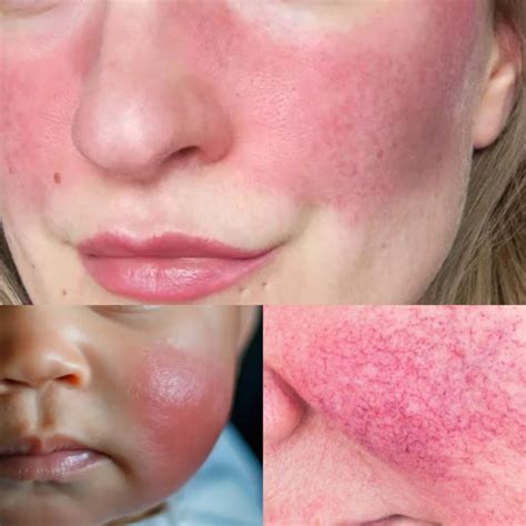 얼굴 홍조 원인 분석 안면홍조 없애는법 5가지 네이버 블로그