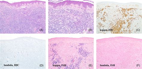 Kappa Light Chain Restricted Multiple Myeloma Shelly Lighting