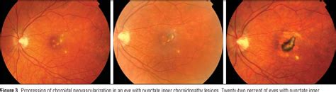 Figure 2 From Punctate Inner Choroidopathy Clinical Features And