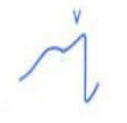 Abnormal CVP Waveforms Matching Flashcards Quizlet